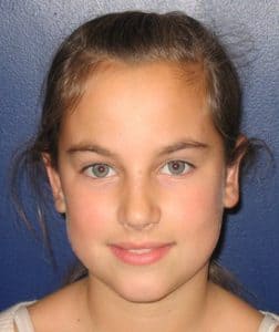 Otoplasty Ear Surgery | Baltimore Plastic & Cosmetic Surgery | (410 ...